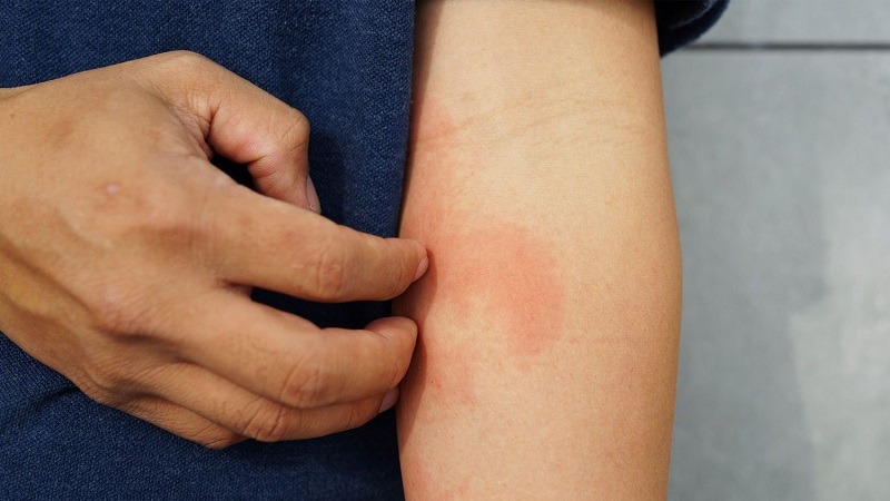 Have an itch, blame the bacteria - Times Kuwait
